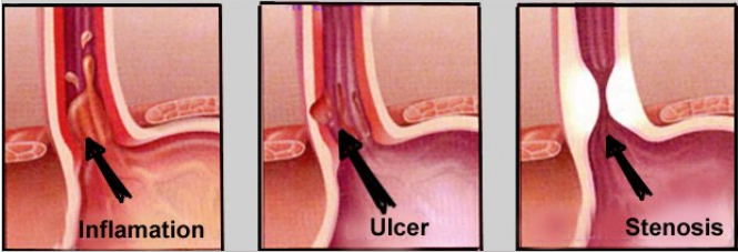 Reflux (GERD) Surgery: Symptoms, Causes, and Treatment