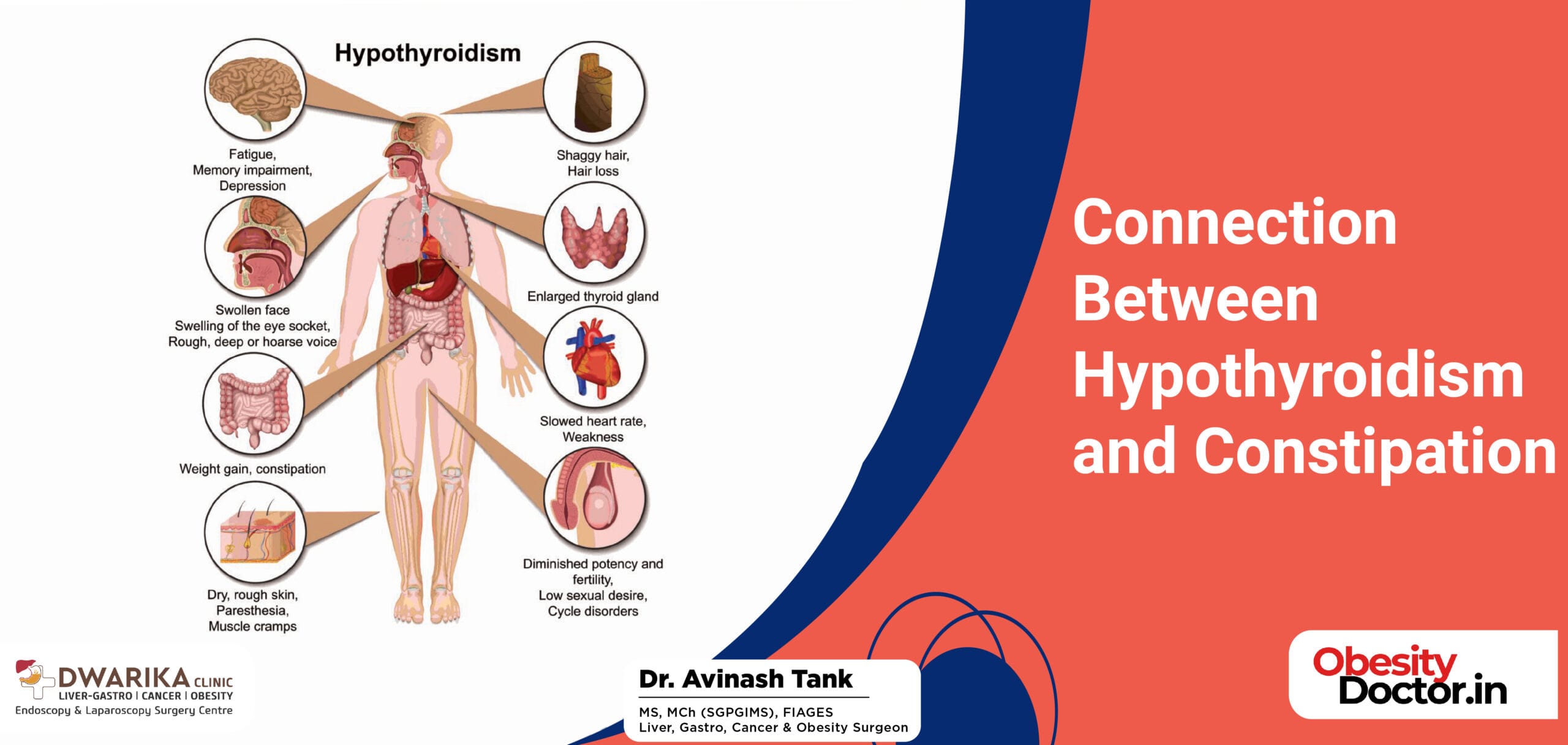Connection Between Hypothyroidism and Constipation - Dr AvinashTank, is ...