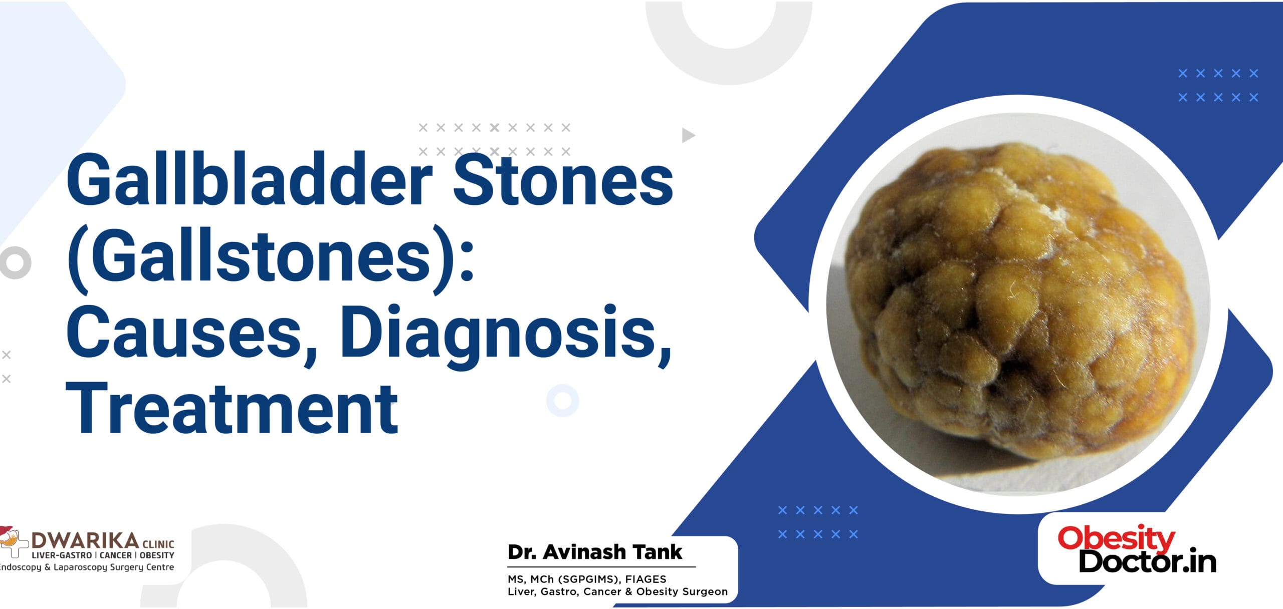 Gallbladder Stones (Gallstones): Causes, Diagnosis, Treatment - Dr ...