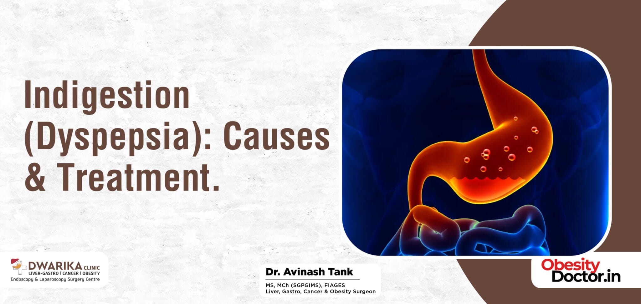 Indigestion (Dyspepsia): Causes & Treatment - Dr AvinashTank, is a ...
