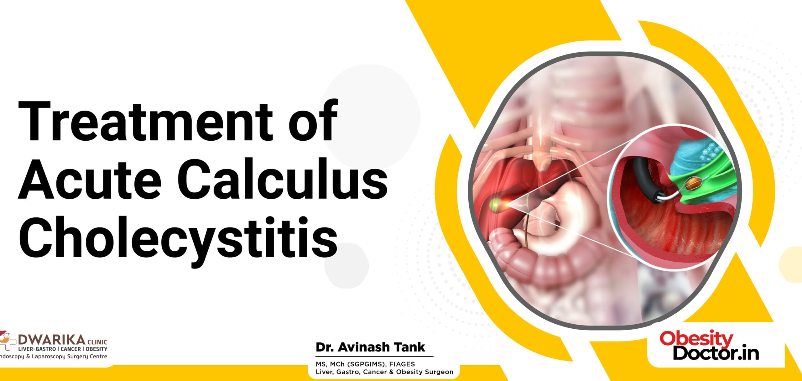 Treatment of Acute Calculus Cholecystitis - Dr AvinashTank, is a super ...