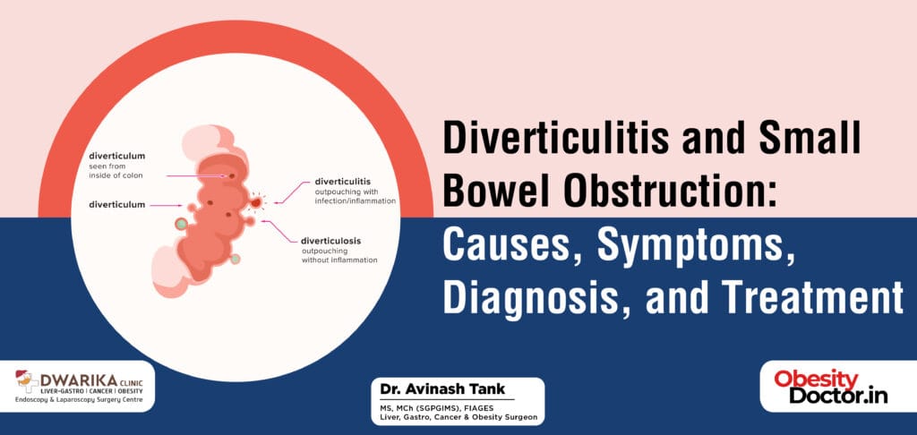 Diverticulitis and Small Bowel Obstruction: Causes, Symptoms, Diagnosis ...
