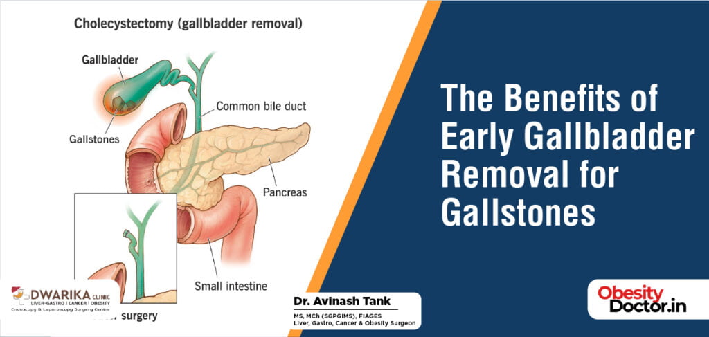 The Benefits of Early Gallbladder Removal for Gallstones - Dr ...