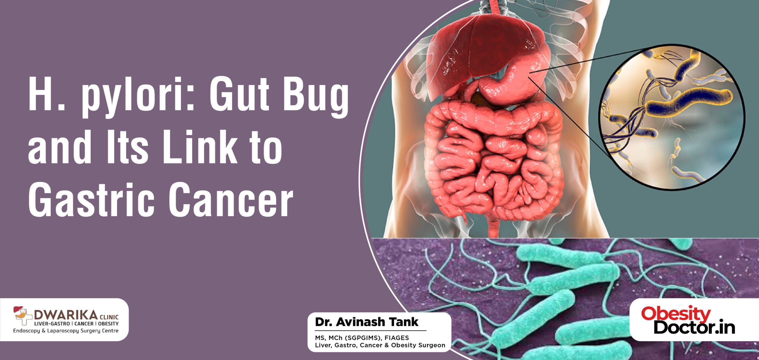 H. pylori: Gut Bug and Its Link to Gastric Cancer - Dr AvinashTank, is ...