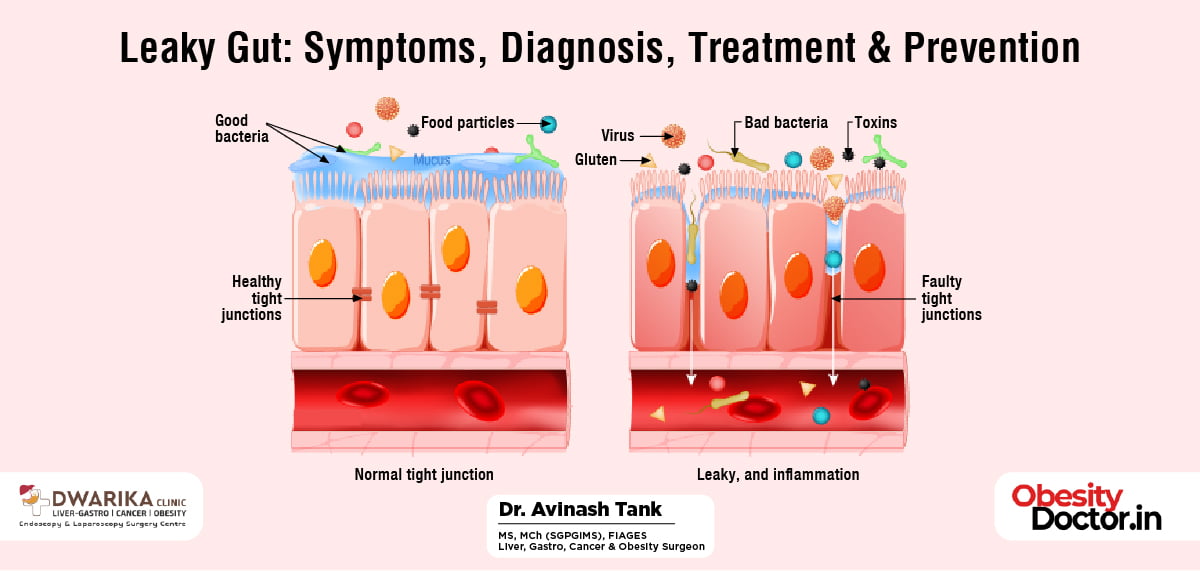 Leaky Gut: Symptoms, Diagnosis, Treatment & Prevention - Dr AvinashTank ...