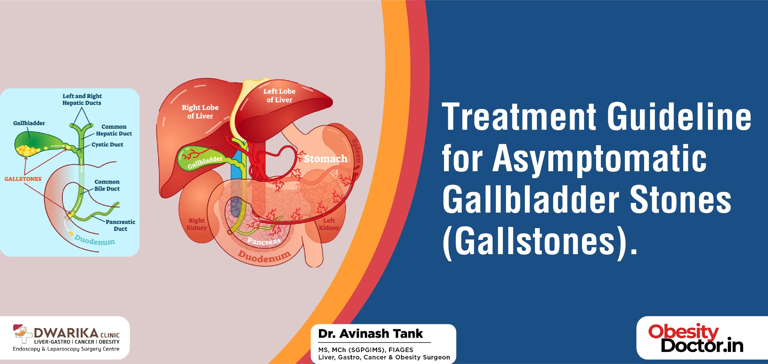 Treatment Guideline for Asymptomatic Gallbladder Stones (Gallstones ...